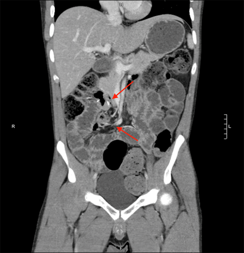 Internal Hernia of Ileocolic Anastomosis through Mesenteric Defect from ...