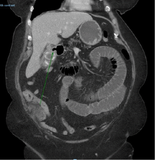 A Rare Case of Recurrent Gallstone Ileus | ACS