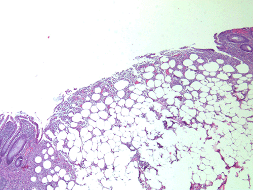 Microscopic Submucosal Lipomas with Mucosal Ulceration Can Be a Cause ...