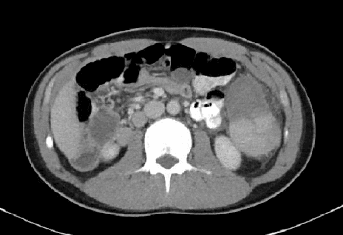 Torsion of a Remarkably Large Accessory Spleen | ACS