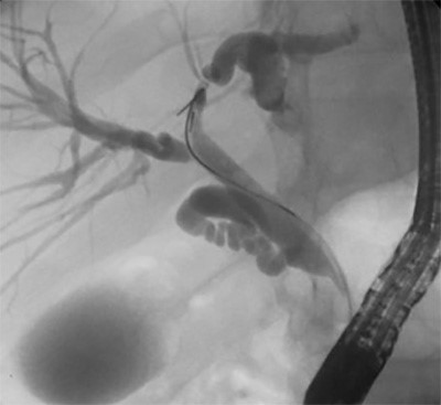 Delayed Traumatic Intracranial Bleeding and Herniation after Initial ...