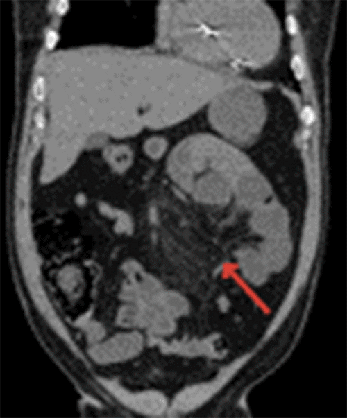 Omental Flap as a Novel Alternative Technique for Closure of a Left ...