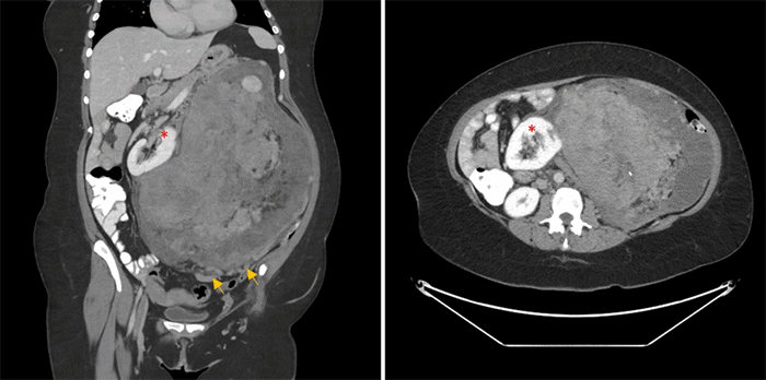 Polycythemia in a Patient with a Large Retroperitoneal Leiomyoma | ACS