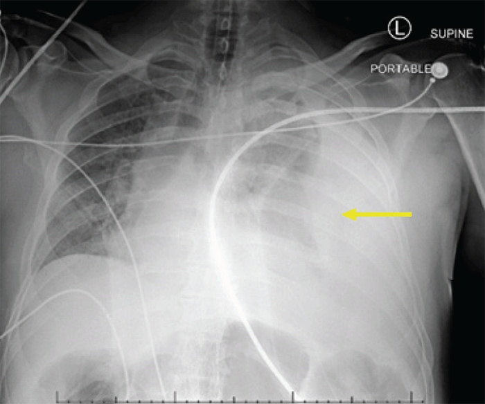 Hemothorax X Ray Dissecting Thoracic Aortic Aneurysm With Left Sided