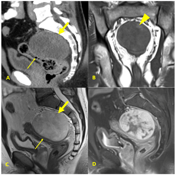 Retrorectal Mass: An Atypical Case Presentation of Metastatic Myxoid ...