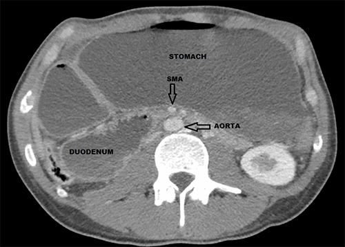Superior Mesenteric Artery Syndrome with Duodenal Obstruction in a ...