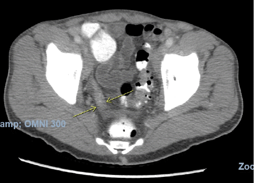 Acute Tip Appendicitis in the Setting of Newly Diagnosed Adult T-Cell ...