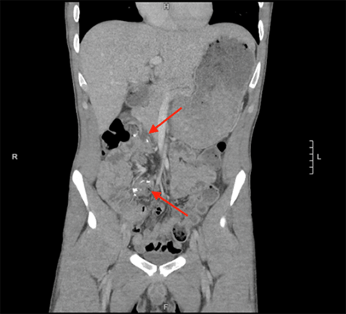 Internal Hernia of Ileocolic Anastomosis through Mesenteric Defect from ...