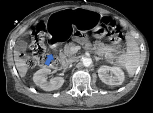 Delayed Presentation of a Duodenal Perforation After Blunt Abdominal ...