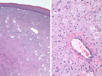Congenital Epulis: Unusual Etiology of Airway Obstruction and Feeding ...