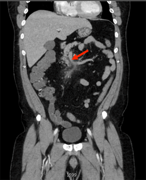 Pylephlebitis Following Laparoscopic Appendectomy for Appendicitis | ACS
