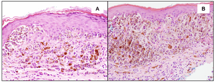 Diagnosis and Management of Vulvar Malignant Melanoma: An Uncommon and ...