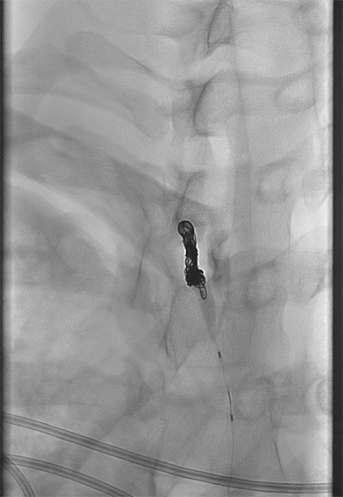 Repeat Thoracic Duct Embolization in Traumatic Thoracic Duct Injury: An ...