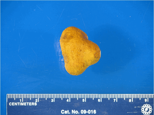 Recurrent Small Bowel Obstruction Due to Jejunal Diverticular ...