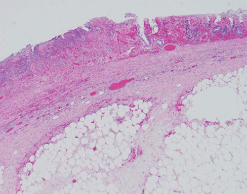 Submucosal Sigmoid Lipoma Acting as Unusual Lead Point of Colocolic ...