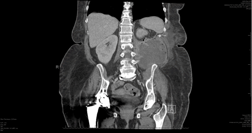 Pyelocolonic Fistula in a Patient with a Large Staghorn Calculus and ...