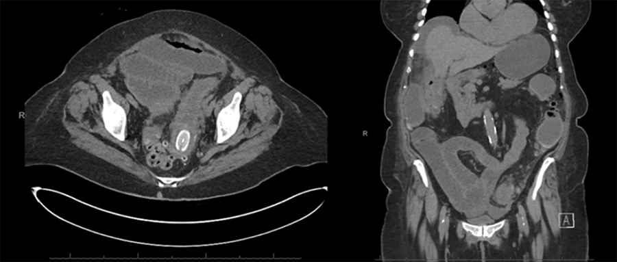 Colonic Obstruction and Perforation Due to Gallstone Ileus | ACS
