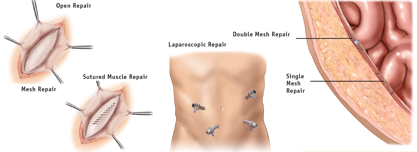 Ventral Hernia Repair | ACS