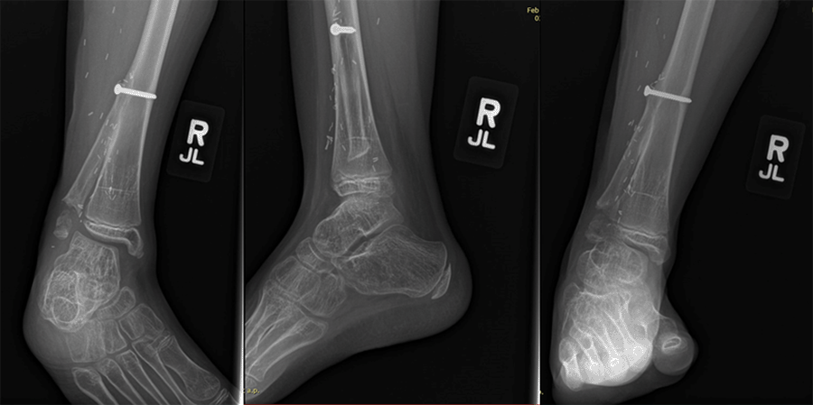 Free Microvascular Transfer of the Proximal Fibular Epiphysis to ...
