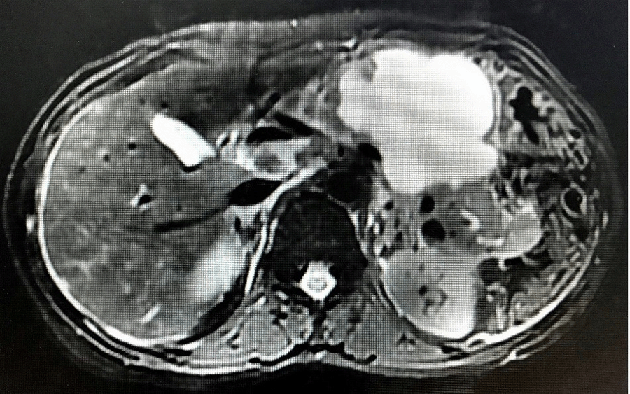 A Different Presentation of Primary Pancreatic Tuberculosis in an ...