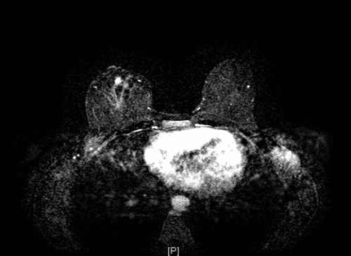 Surgical Treatment of a Primary Angiosarcoma of the Breast | ACS
