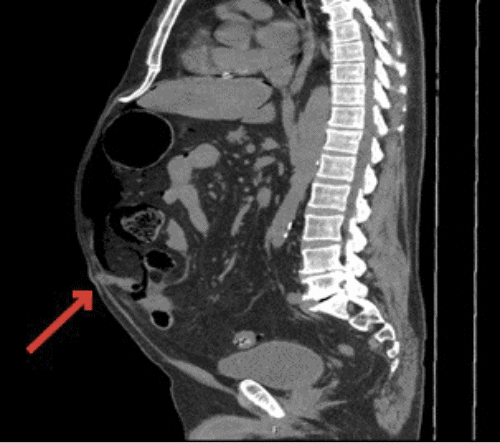 Perforated Umbilical Littre Hernia with Familial Component | ACS