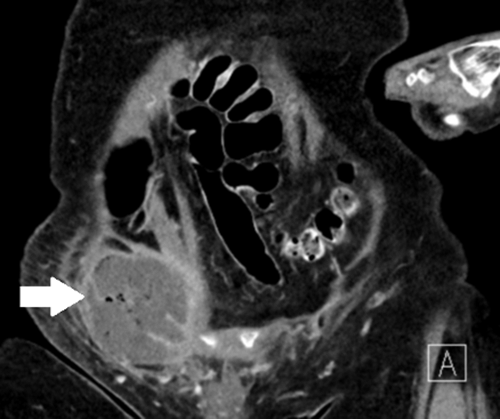 Amyand’s Hernia and Complicated Appendicitis Presenting as an Abdominal ...