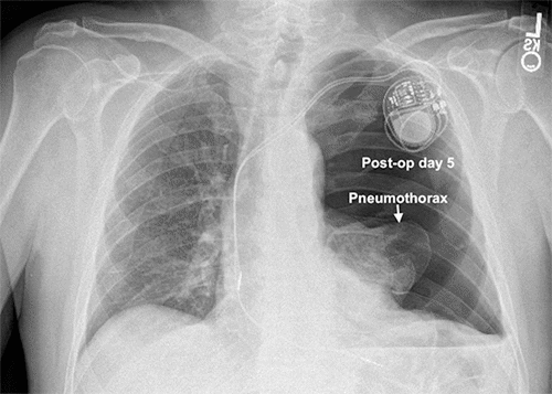 Delayed Pneumothorax and Lead Dislodgement after Pacemaker Insertion in ...