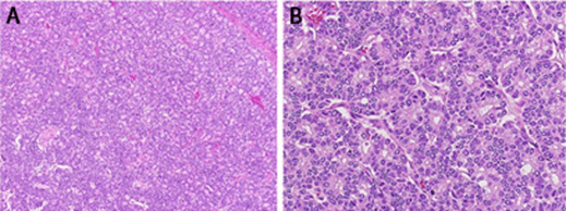 Primary Acinar Cell Carcinoma of the Liver Complicated by Pancreatic ...