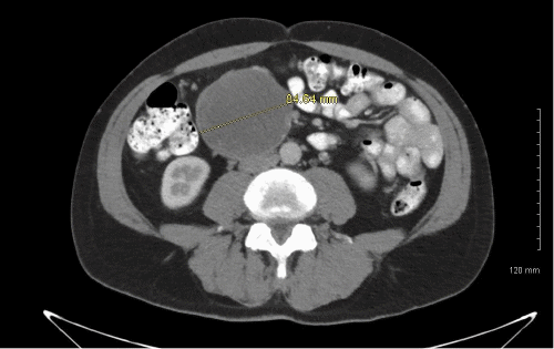 A Complex Intra-Abdominal Epidermoid Cyst: Pancreatic-Duodenal ...