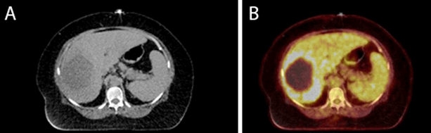 Primary Acinar Cell Carcinoma of the Liver Complicated by Pancreatic ...
