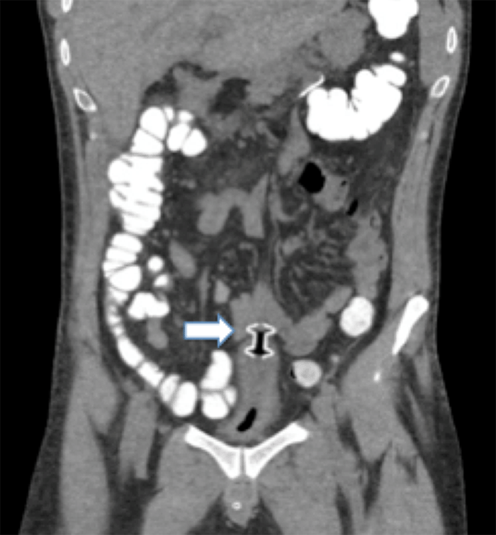 The Poppy Seed Test for Enterovesical Fistula | ACS