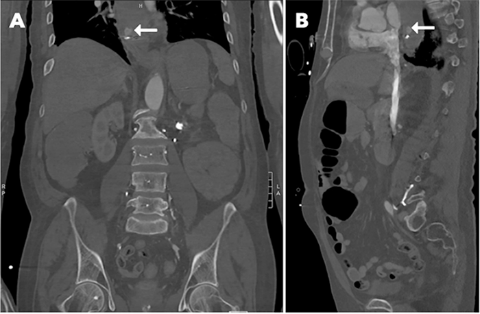 Minnesota Tube Utility in Non-Variceal Distal Esophageal Hemorrhage ...