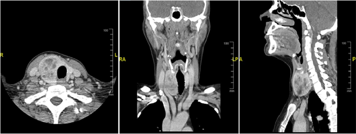 Unexpected Diagnosis of Sporadic Medullary Thyroid Carcinoma | ACS
