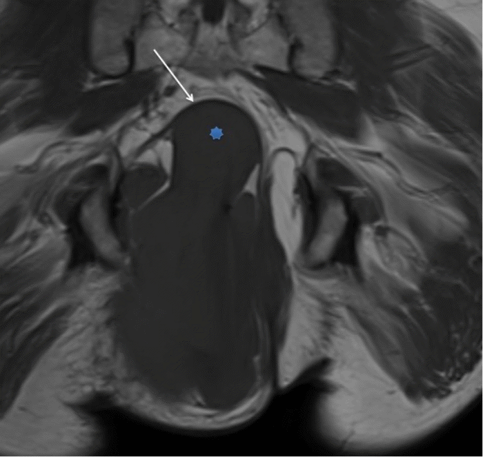 Surgical Approach for a Gluteal Neurofibroma | ACS