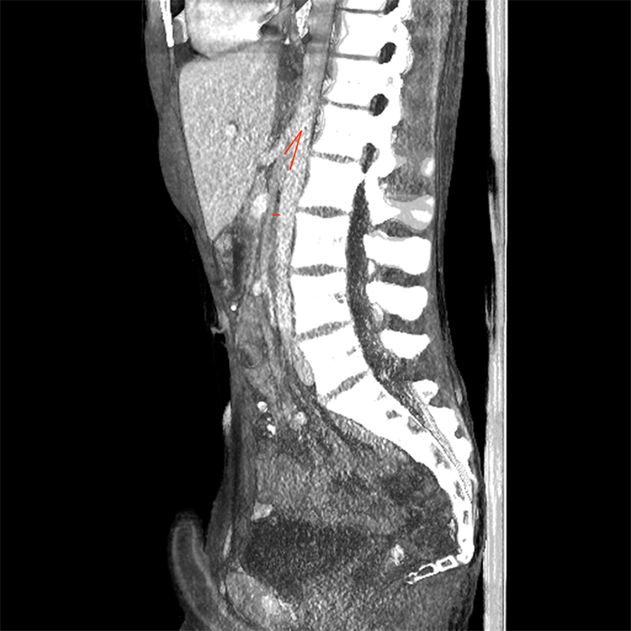 Popcorn Bezoar Mimicking Superior Mesenteric Artery Syndrome | ACS