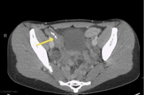 Beyond the Obvious: Appendiceal Endometriosis Presenting as Acute ...