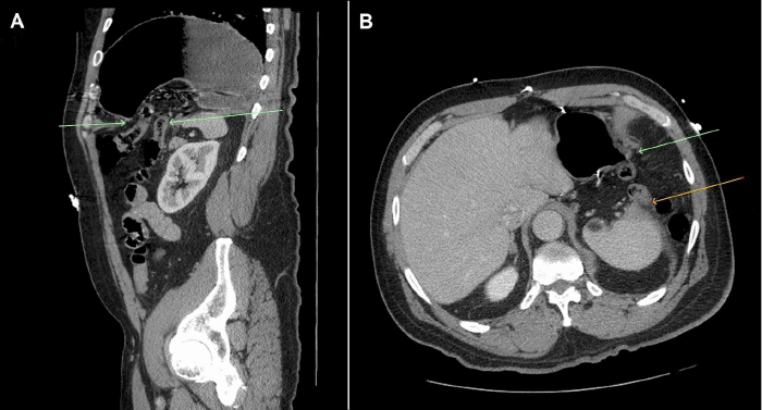 Delayed Traumatic Diaphragmatic Hernia Masquerading as COPD ...