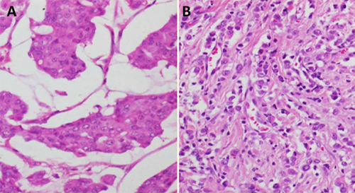 Bilateral Breast Cancer: Different in More Ways than One | ACS