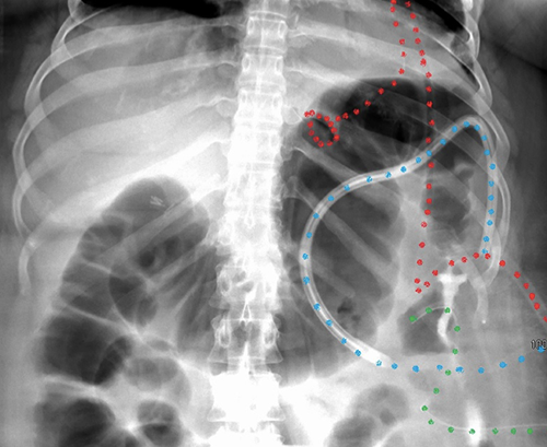 A Minimally Invasive Approach to Persistent Gastric Staple-Line Failure ...