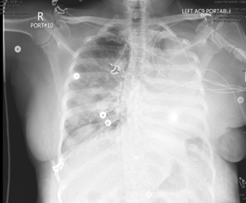 Left Lower Torsion Following Lobectomy, Successfully Managed with ...
