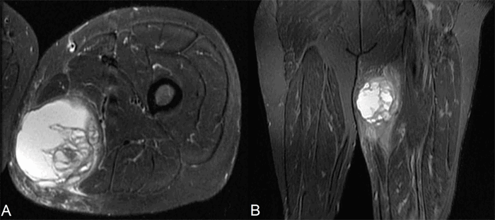 Extraskeletal Osteosarcoma Misdiagnosed as Soft Tissue Sarcoma | ACS