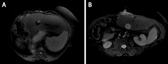 Primary Acinar Cell Carcinoma of the Liver Complicated by Pancreatic ...