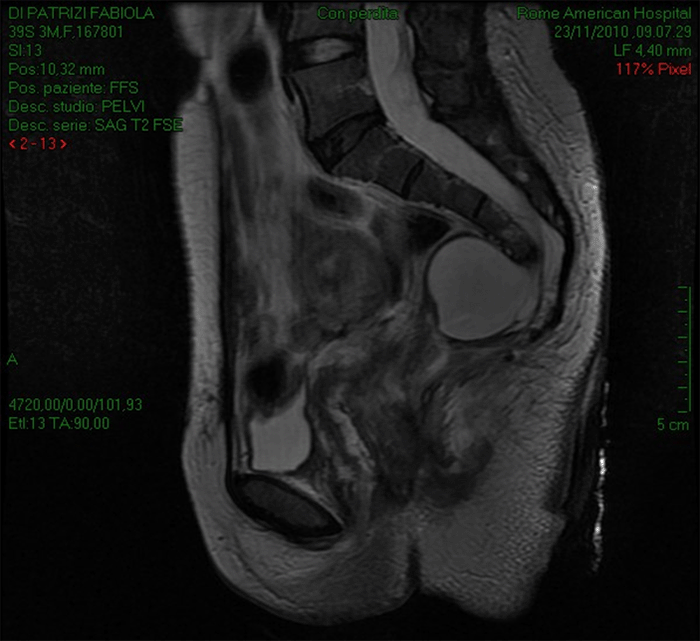 Perianal Abscess Mri
