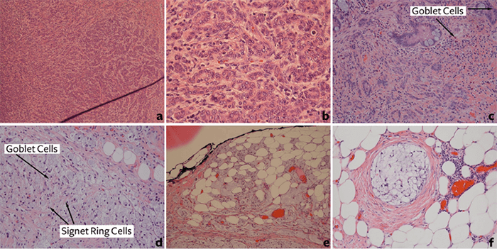 Surgical Management of Incidental Appendiceal Adenocarcinoma Ex-Goblet ...