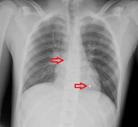 Gunshot Wound to Chest with Embolization of Pellet into the Left ...