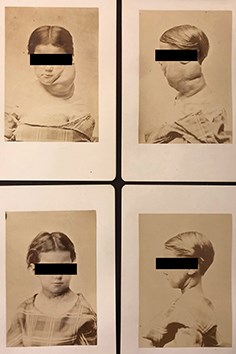 Susan Dimock, MD, pioneering American physician | ACS