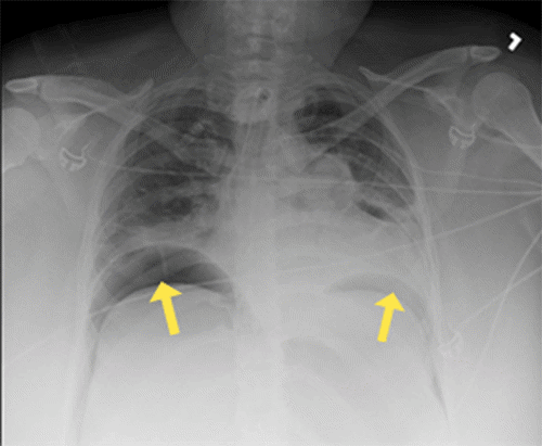 Tension Pneumoperitoneum after Percutaneous Endoscopic Gastrostomy Tube ...