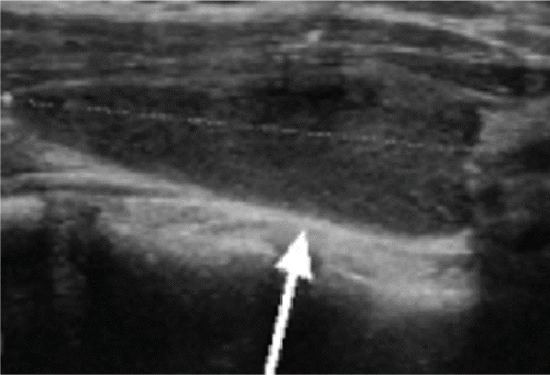 Delayed Absorption of Oxidized Cellulose (Surgicel®) Mimicking Residual ...