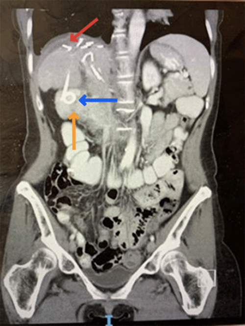 Endoscopic Ultrasound-Guided Drainage of a Complex Subphrenic ...